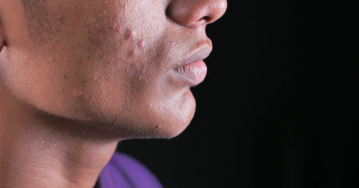 Comprendre la dermite séborrhéique - La Maison de Santé