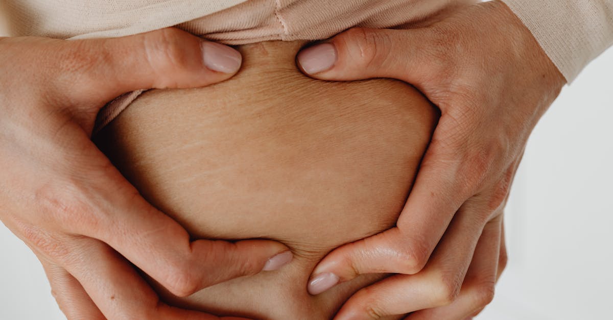 Comprendre les vergetures - La Maison de Santé