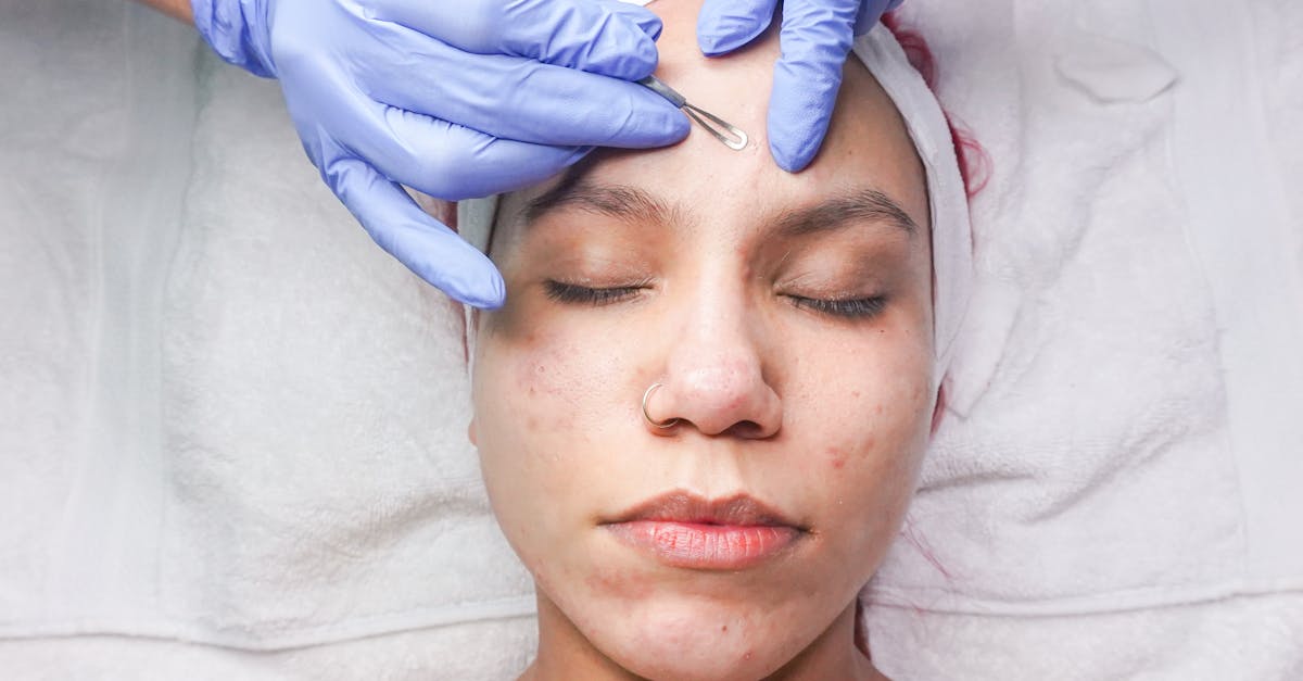 Traitement de l’acné : comprendre les causes et les solutions efficaces ...